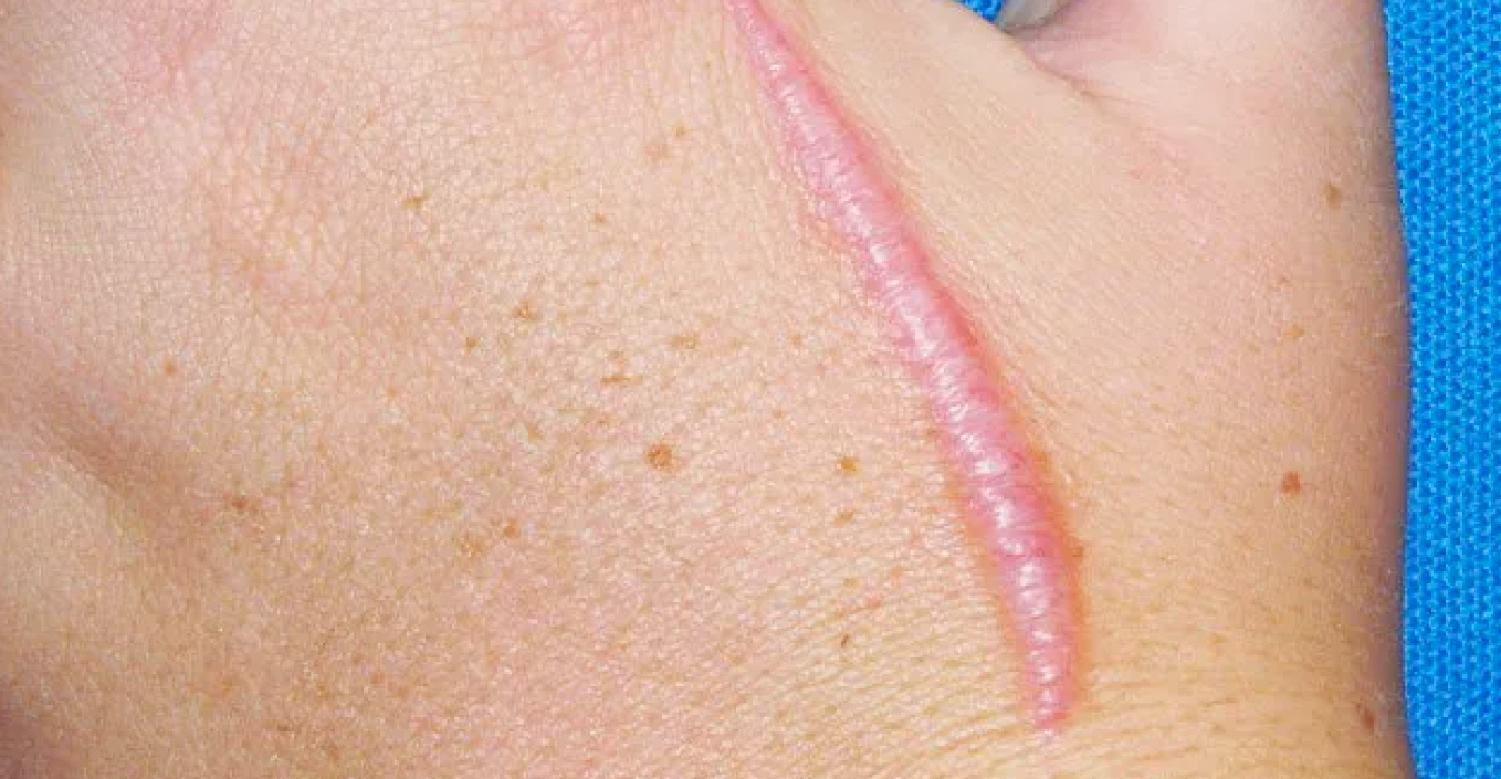 Técnicas Y Tratamiento De Cicatrices | Omicroart